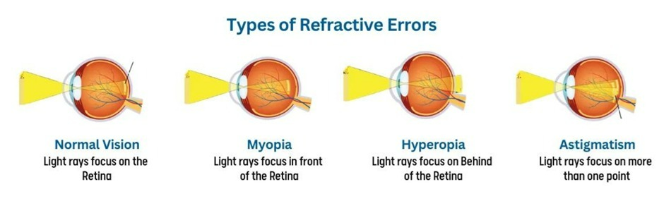 Wavelight Plus InnovEyes Surgery | CFS